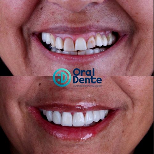 Antes e depois de facetas em resina – Oral Dente