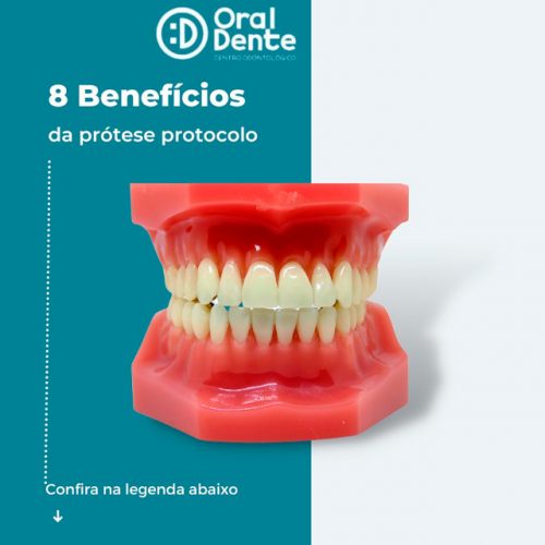 8 benefícios da prótese protocolo – Oral Dente